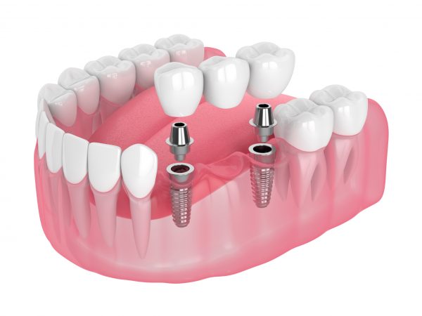 Ako sa starať o zubný mostík? - Schill Dental Clinic